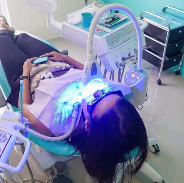 Memutihkan Gigi dengan Bleaching | Airis Dental Clinic