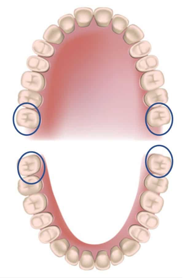 Gigi Bungsu Sakit, Apa yang Harus Dilakukan? | Airis Dental Clinic