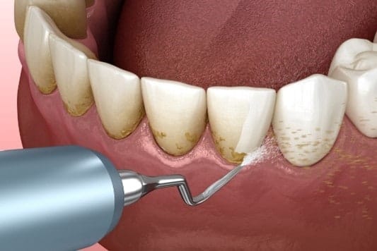 Hal-Hal yang Perlu Diketahui tentang Scaling | Airis Dental Clinic